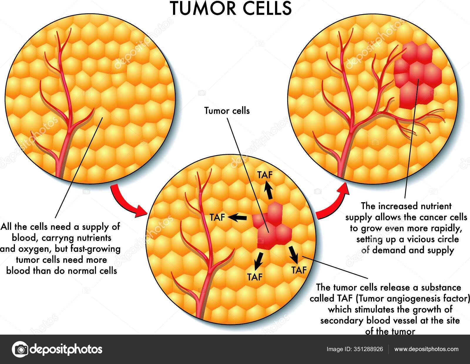 Vector Medical Illustration Formation Tumor Cells Stock Vector Image by ...