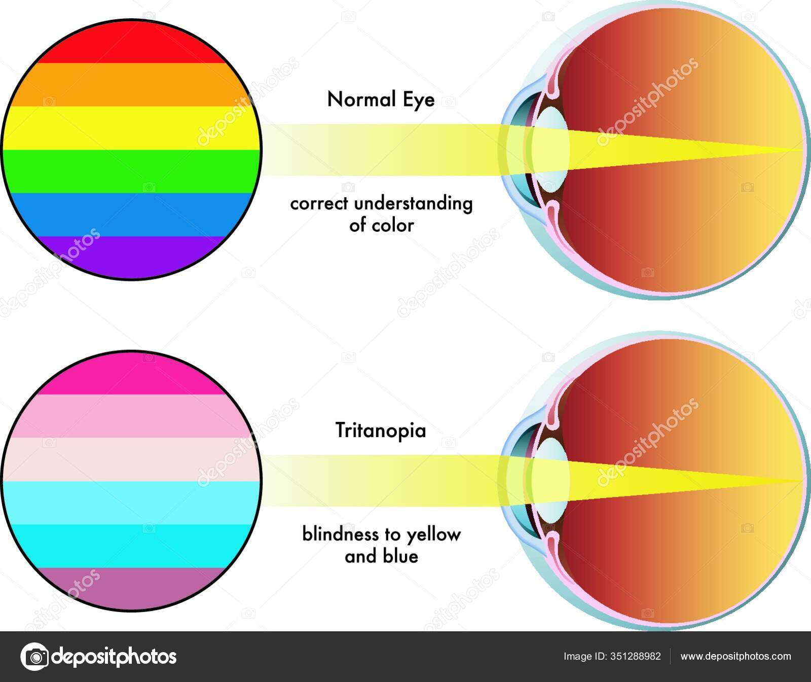 Vector Medical Illustration Symptoms Tritanopia Stock Vector Image by ...
