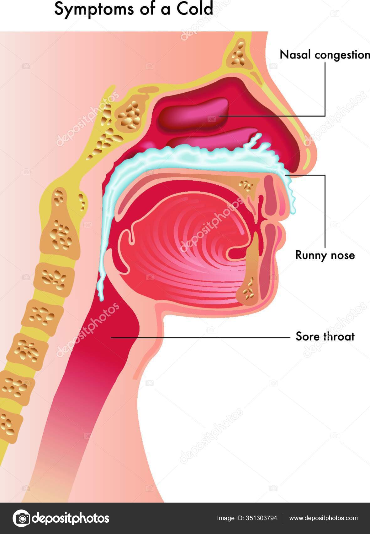 Medical Illustration Upper Respiratory Tract Person Symptoms Common ...