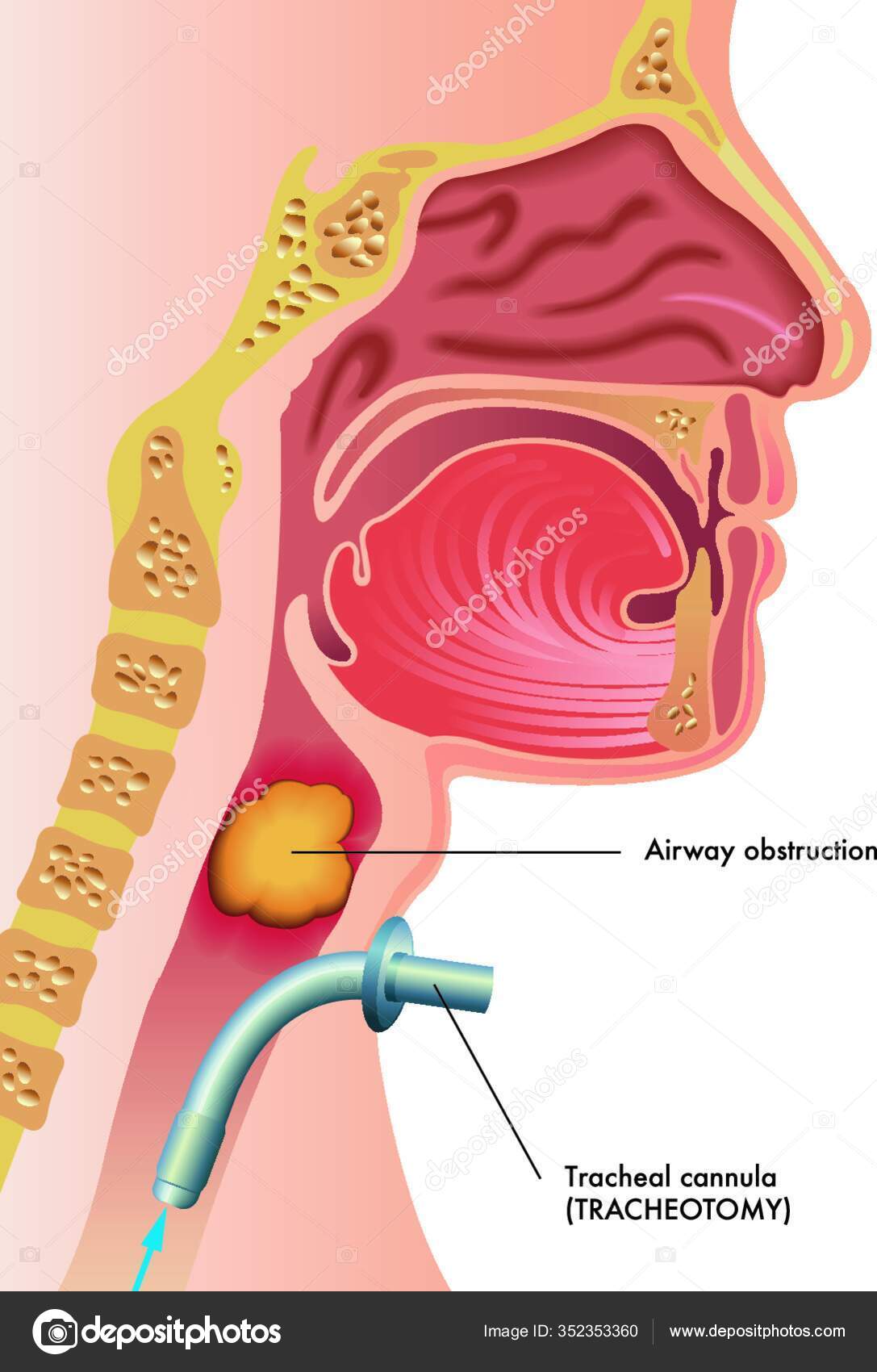 Medical Illustration Surgical Tracheotomy Stock Vector by ...