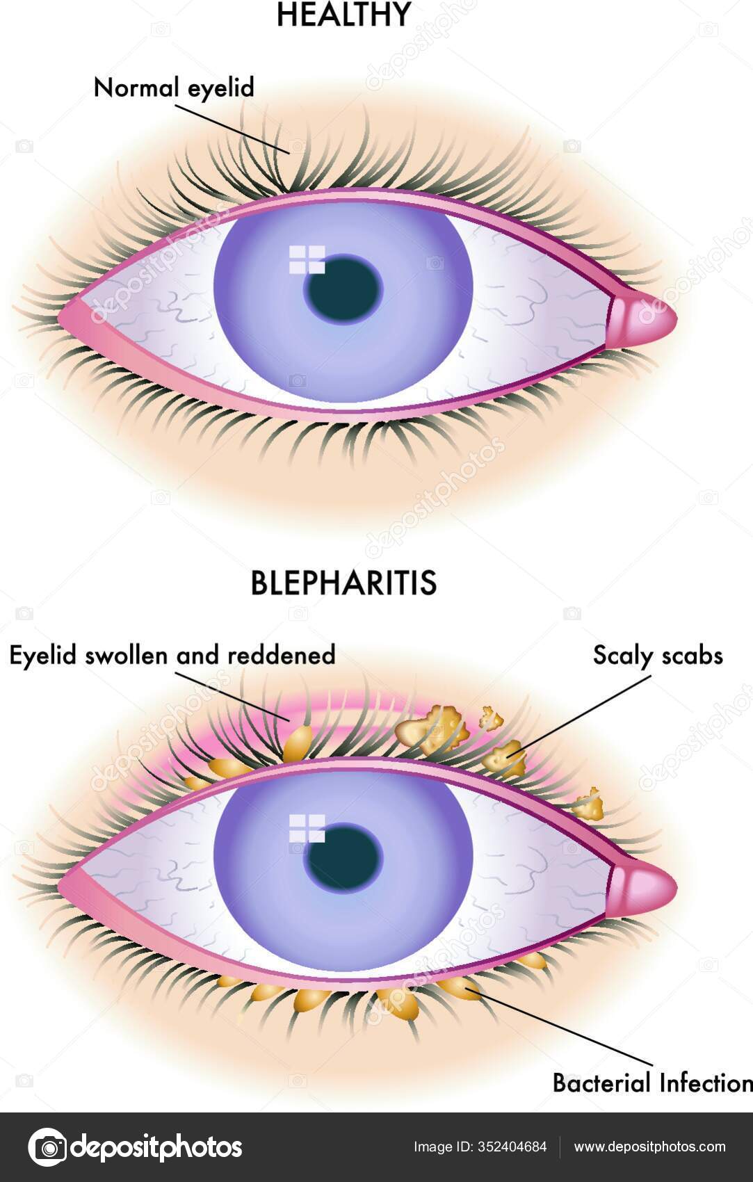 Medical Illustration Symptoms Blepharitis Stock Vector Image by ...