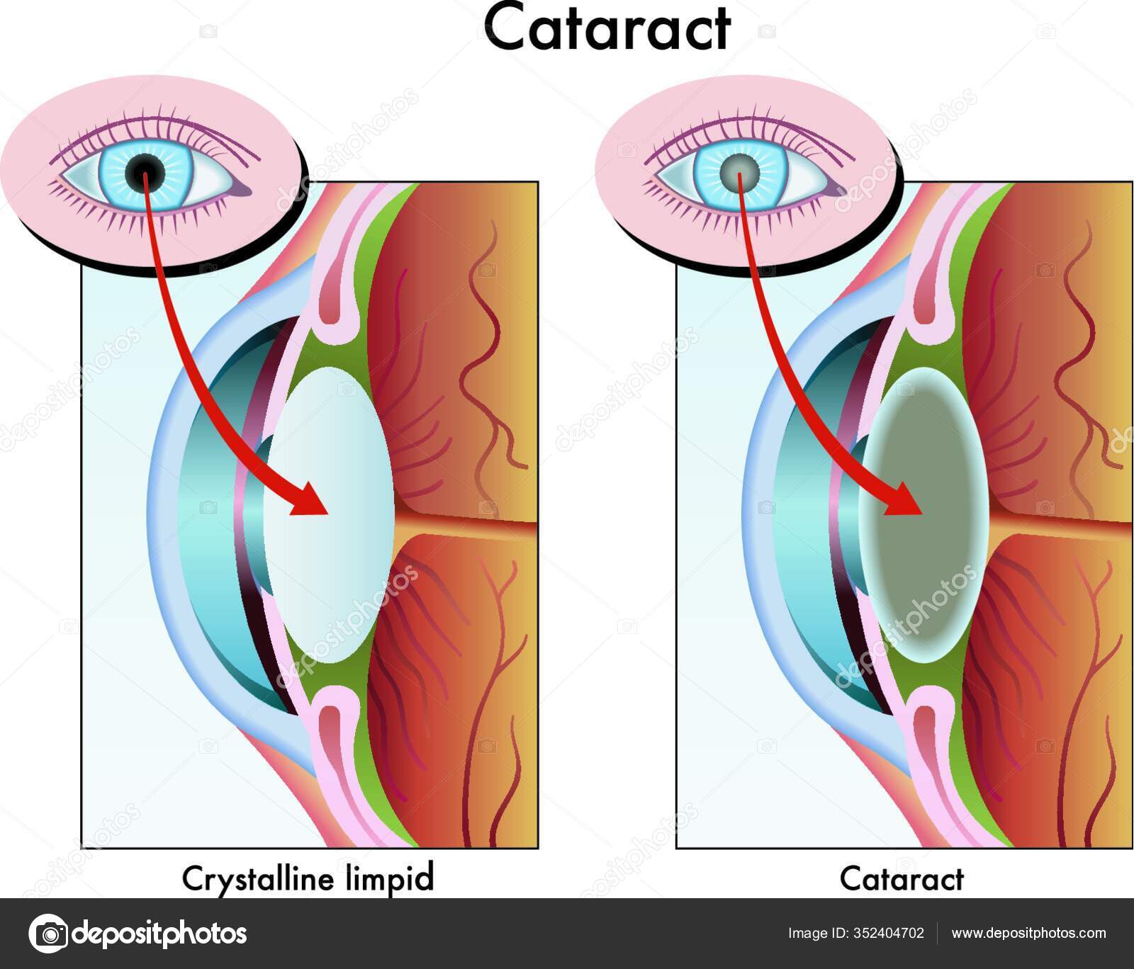 Medical Illustration Effects Cataract Stock Vector Image by ...