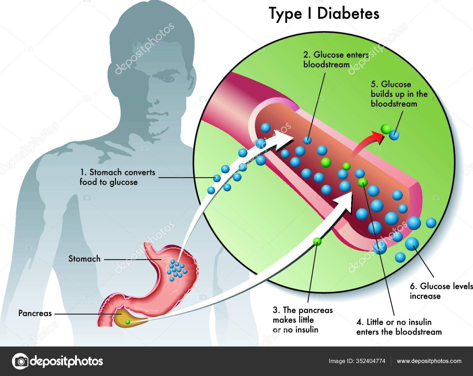 Medical Illustration Symptoms Type Diabetes Stock Vector Image by ...