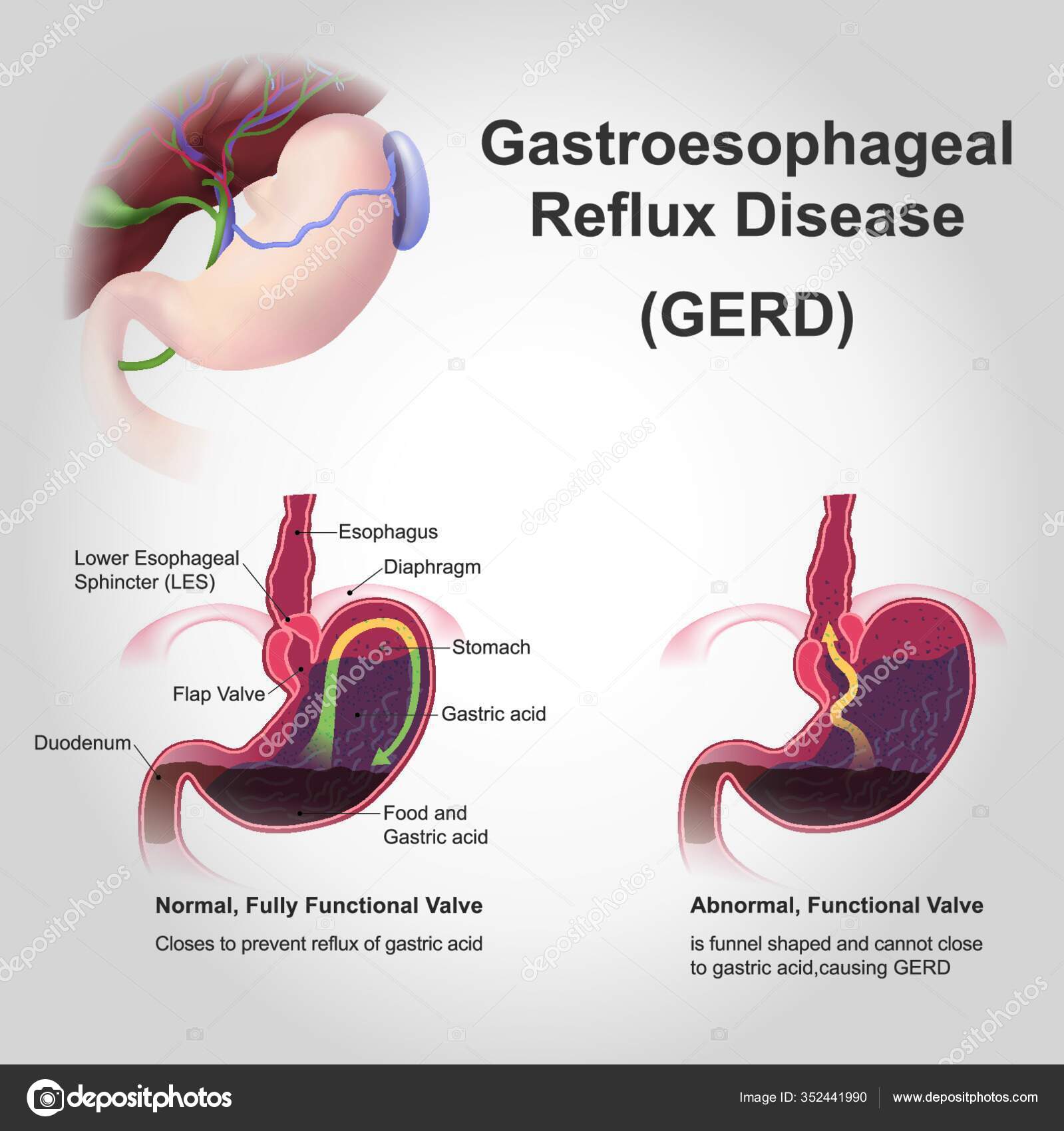 Gastroesophageal Reflux Disease Gerd Also Known Acid Reflux Long Term ...