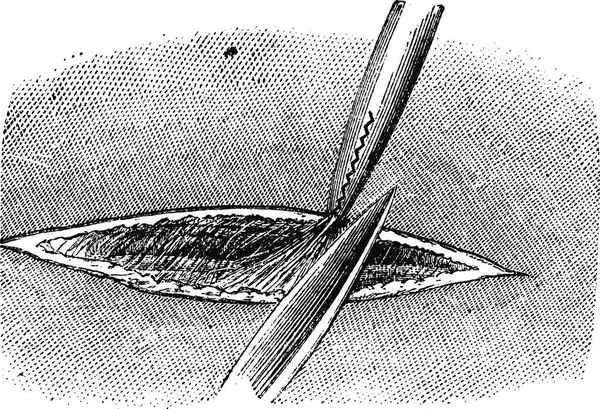 Iridectomy Using Desmarres Procedure Vintage Engraved Illustration ...