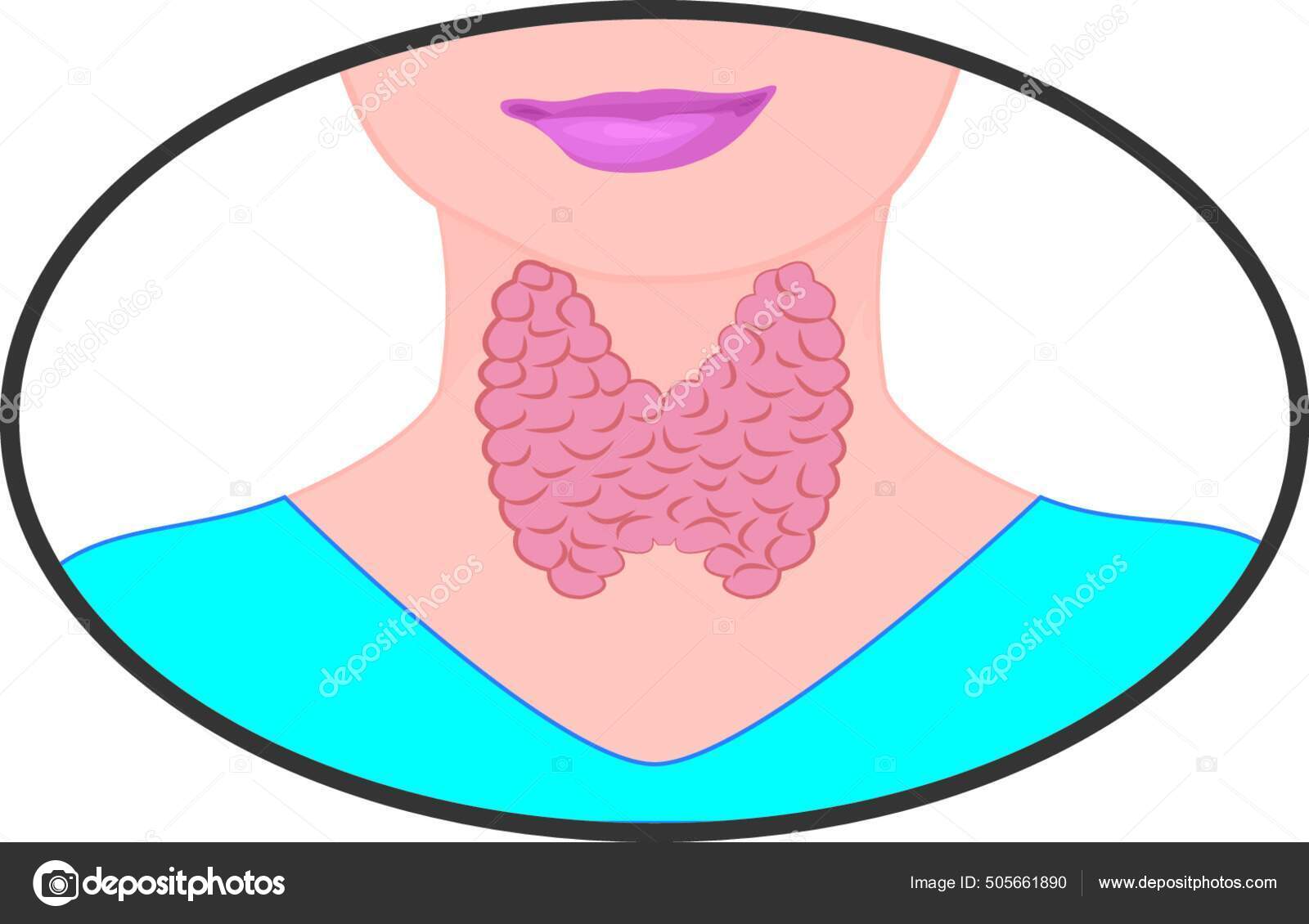 Bocio Tiroides Agrandada Ilustración Vectorial Disfunción Endocrina ...