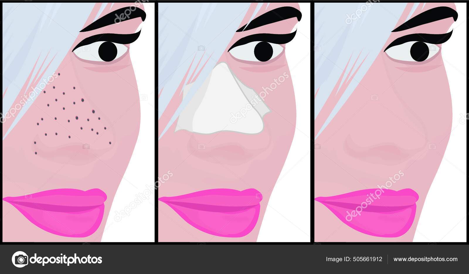 Blackheads Nose Treatment Pore Reduce Skin Problems Vector Illustration Stock Vector by ...