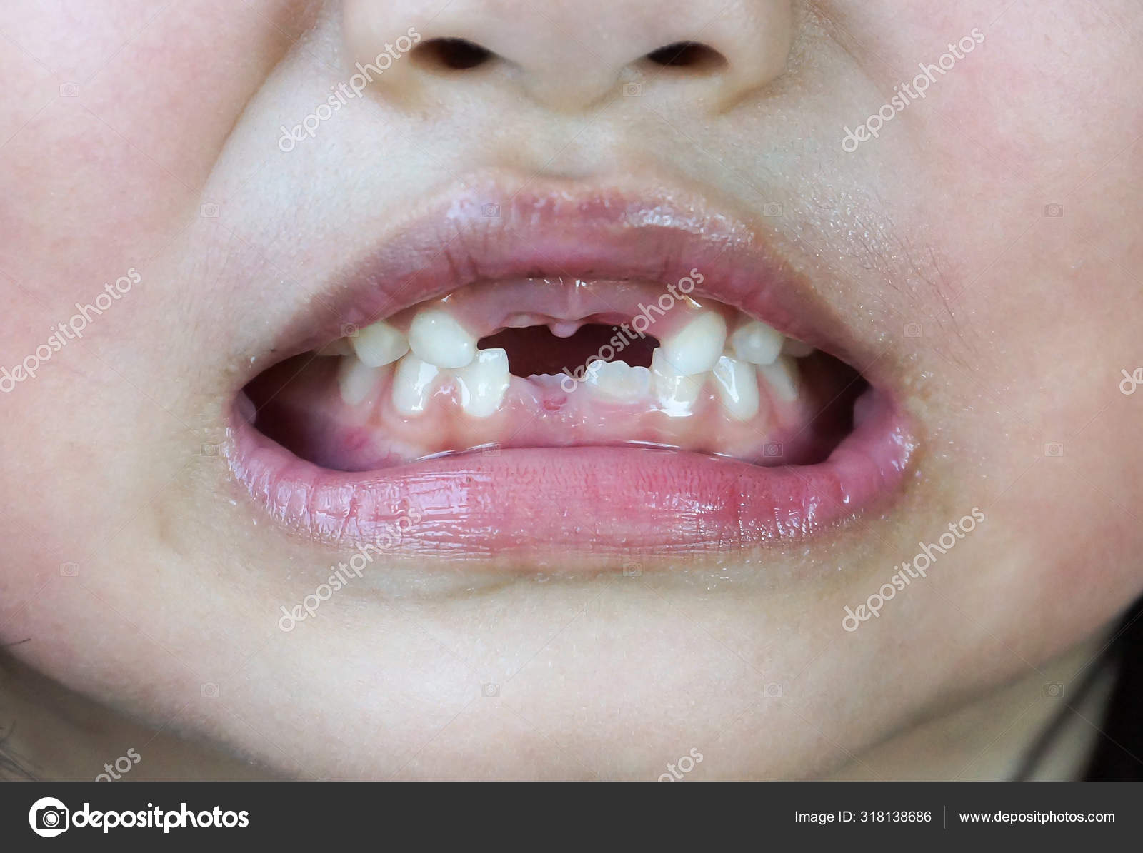 Kid Losing Baby Teeth New Permanent Teeth Coming Out — Stock Photo ...