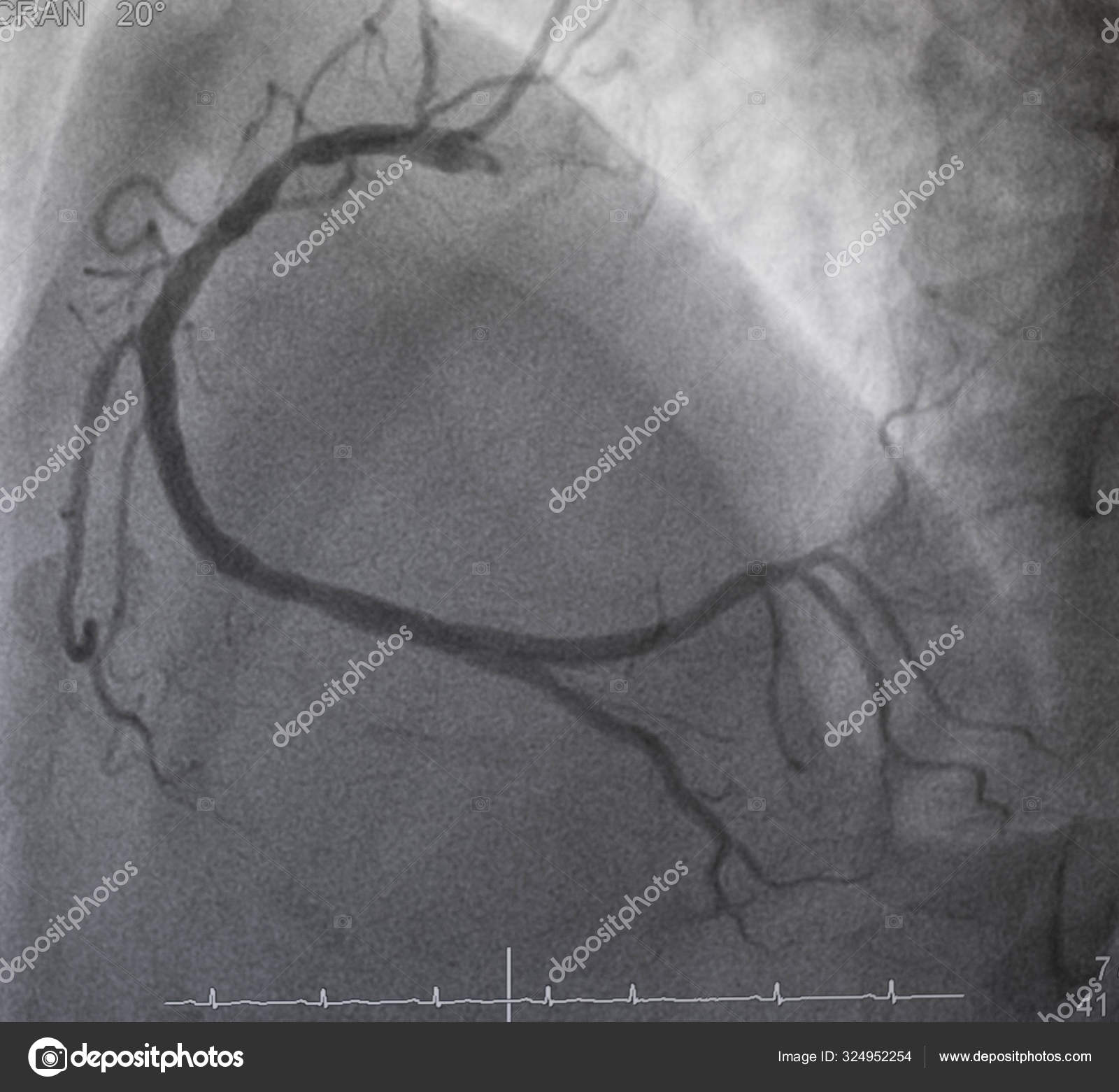 Coronary Angiography Right Coronary Angiography Stock Photo by ...
