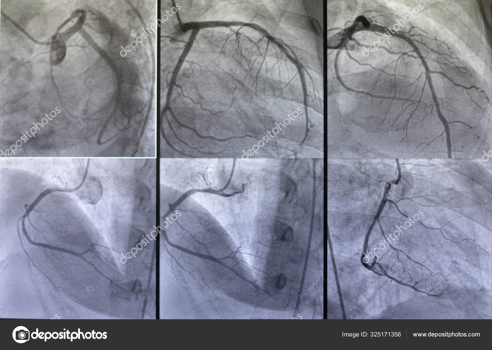 Coronary Angiography