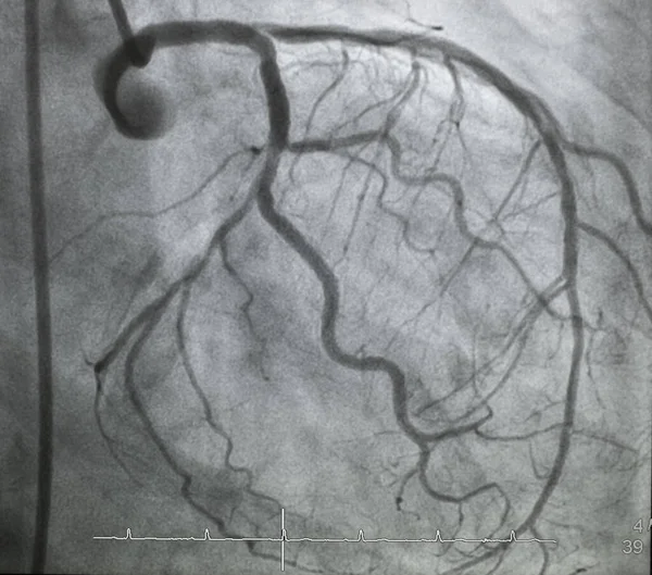 Coronary Angiography Left Coronary Angiography Stock Photo by ...