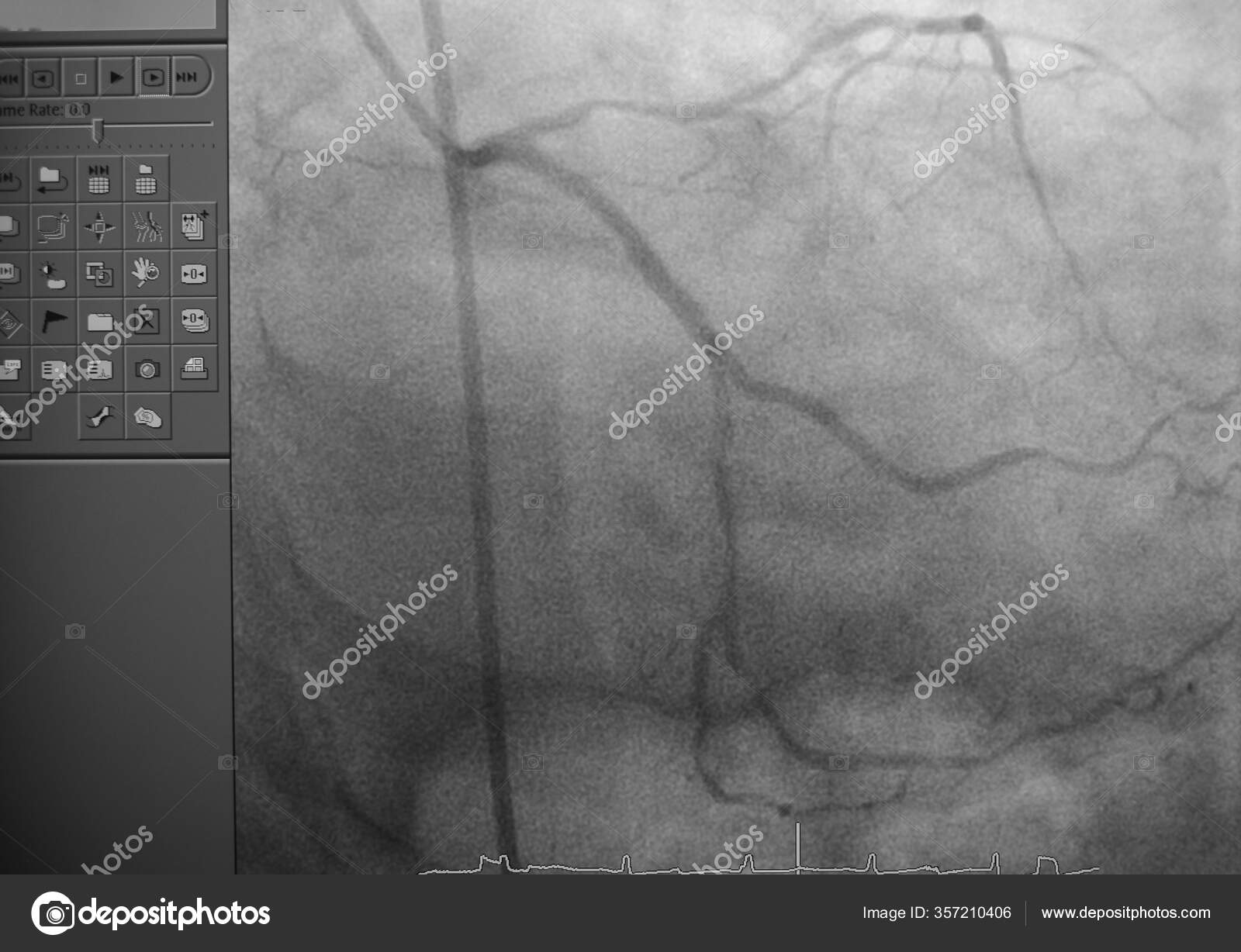 Coronary Angiography Left Coronary Angiography — Stock Photo ...