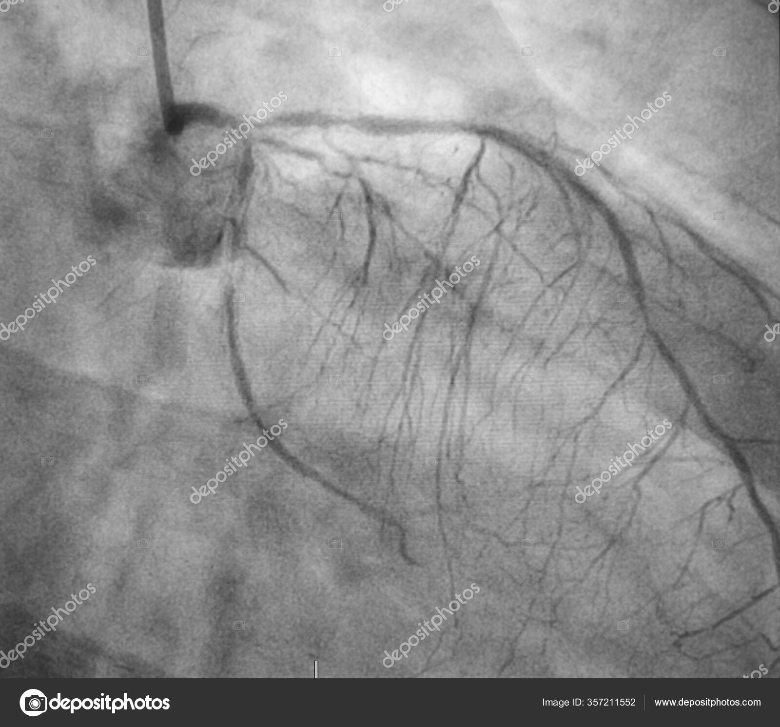 Coronary Angiography Left Coronary Angiography — Stock Photo ...