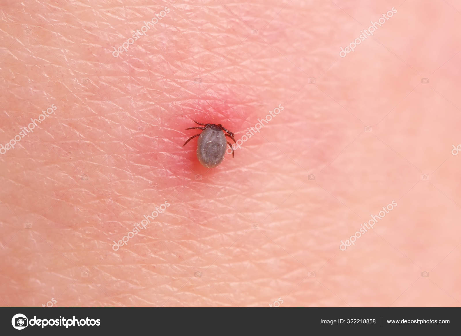 De teek bijt de persoon, gezogen diep onder de huid ⬇ Stockfoto ...