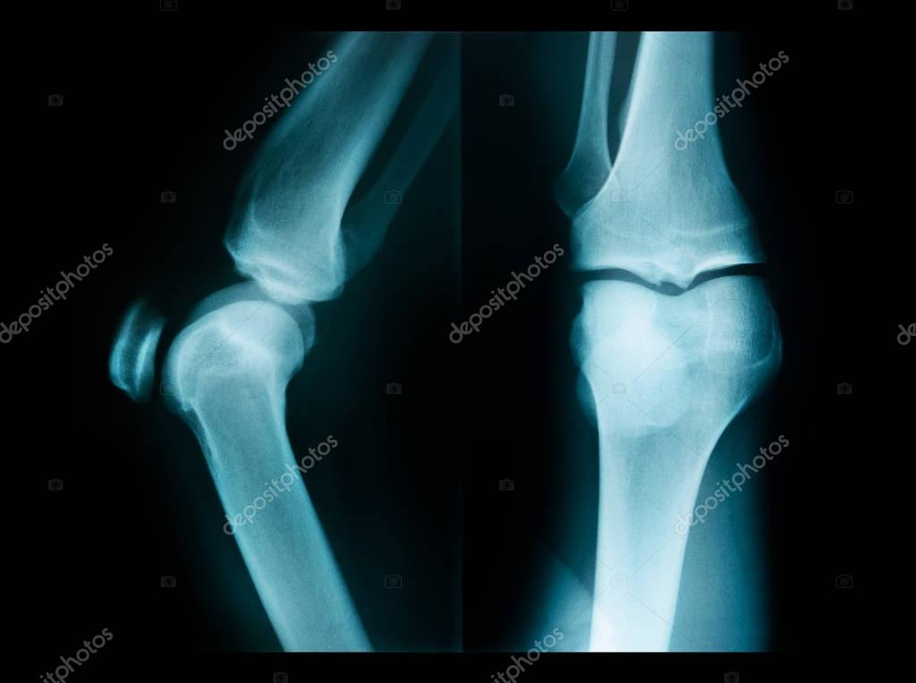 Fotos de Imagen de rayos X que muestra articulaciones de rodilla ...