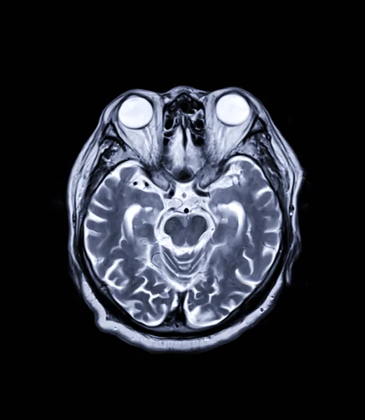 Mri Brain Axial Flair Detect Stroke Disease Brain Tumors Cysts Stock Photo by ©samunella 588588454