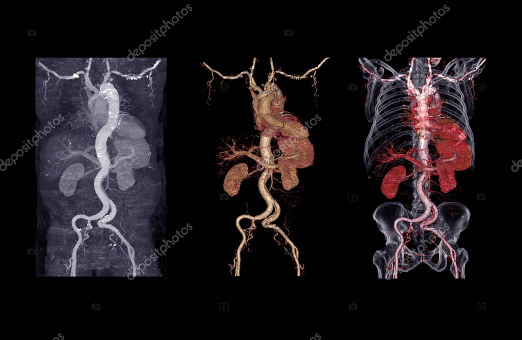 colección de imagen de representación de la aorta abdominal 3D de la ...