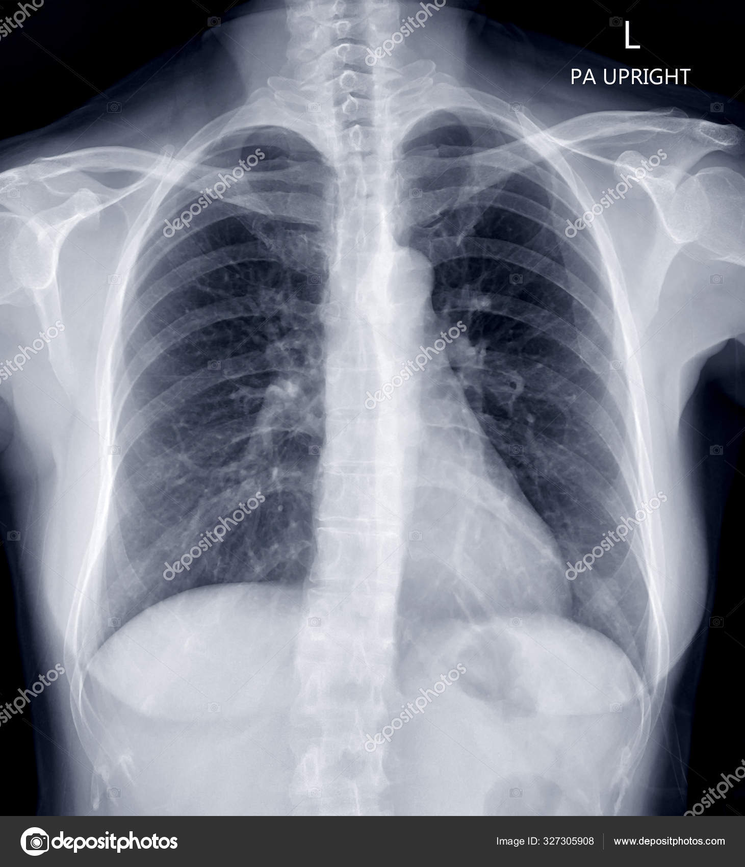 Chest X-ray or X-Ray Image Of human Chest Stock Photo by ©samunella ...