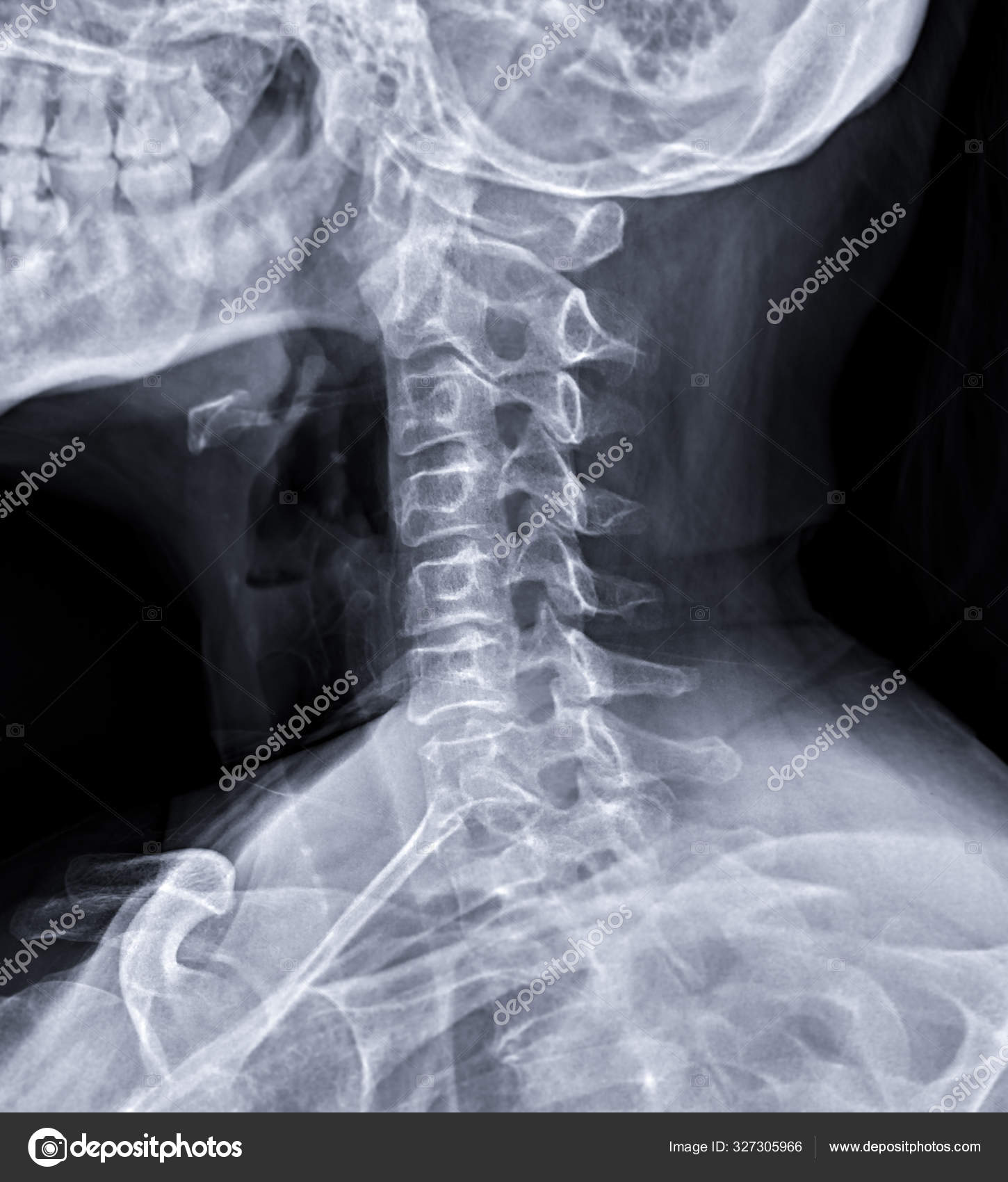 X Ray Cervical Disc Syndrome