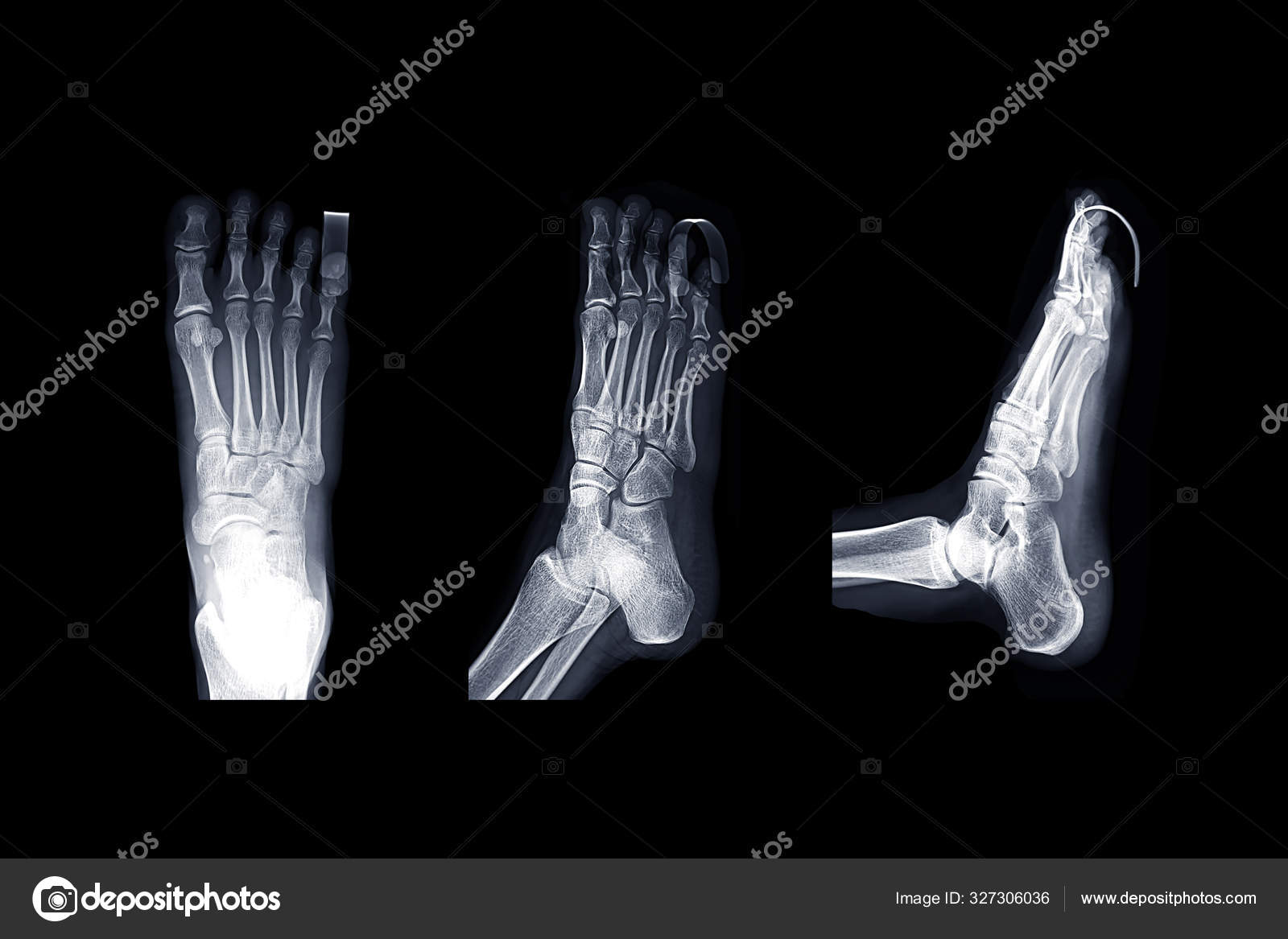 Vista Lateral Del Pie Derecho