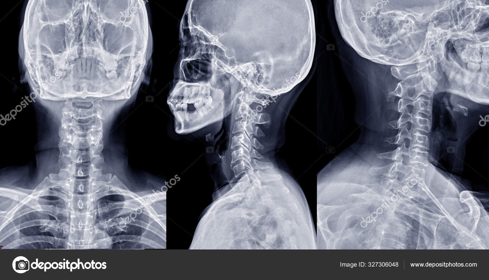 Recopilación Radiografía Columna Radiografía Columna Cervical Vista ...