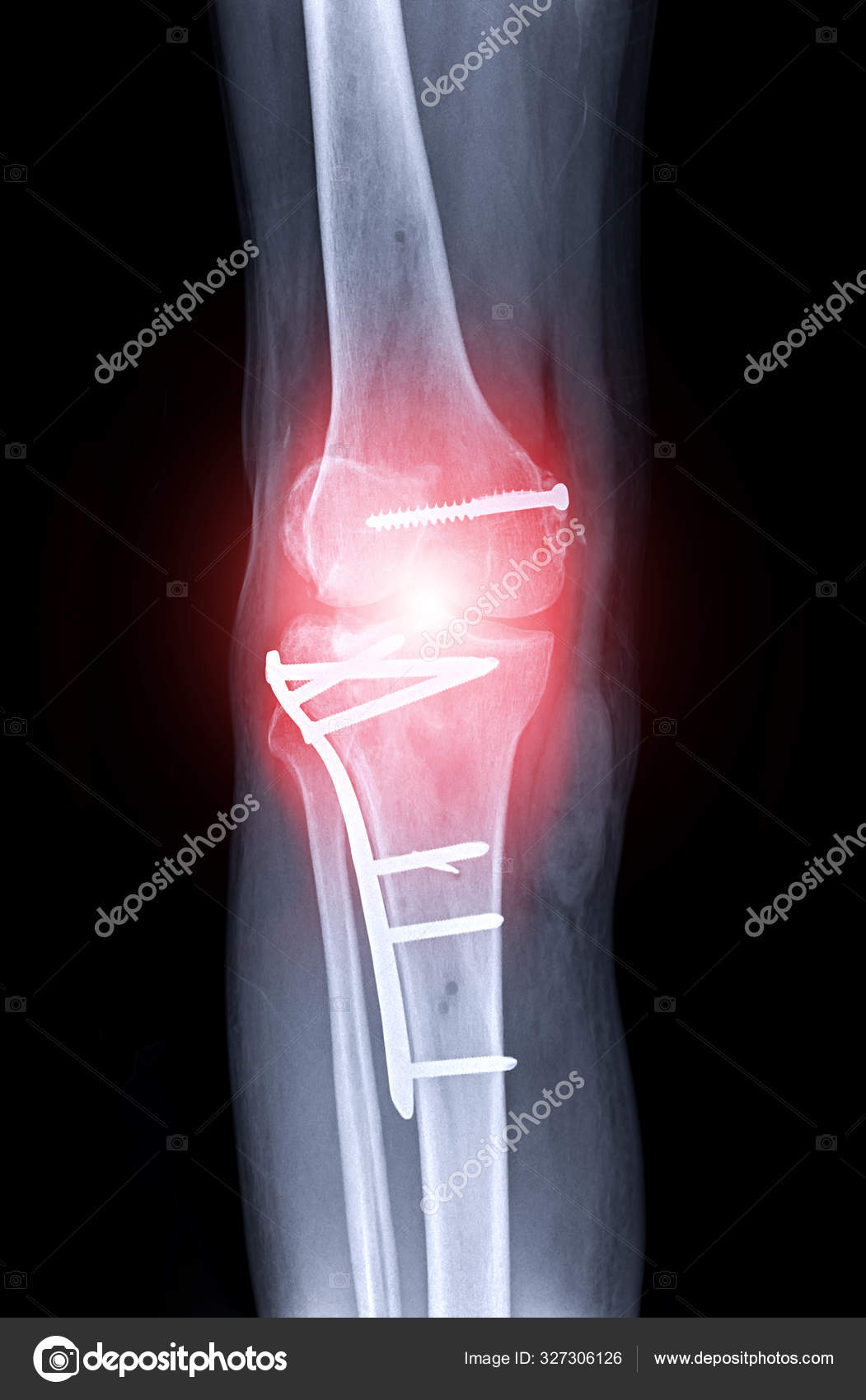 Anatomía De La Meseta Tibial