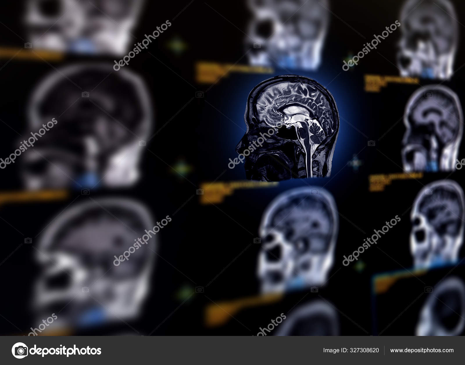 Selective Focus Mri Brain Sagittal Plane Detect Variety Conditions ...