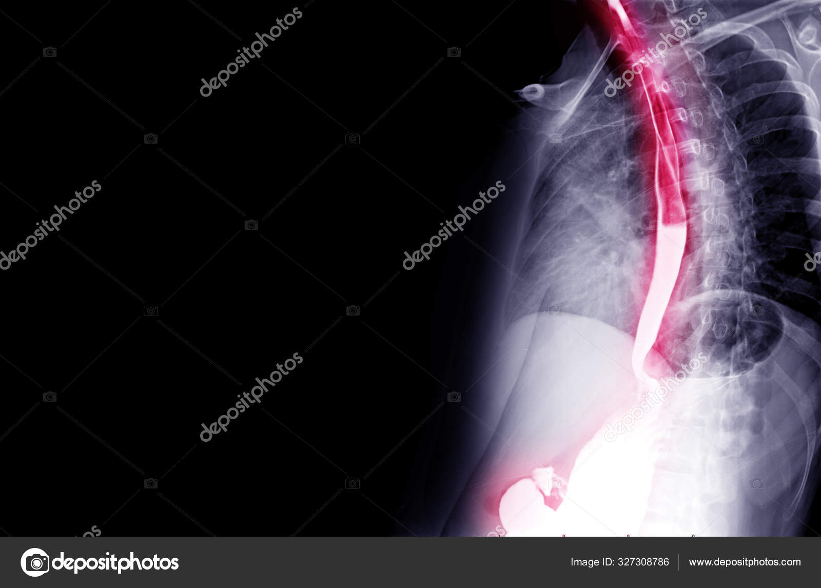 Esophagram Barium Swallow Oblique View Backdrop Medical Concept — Stock ...