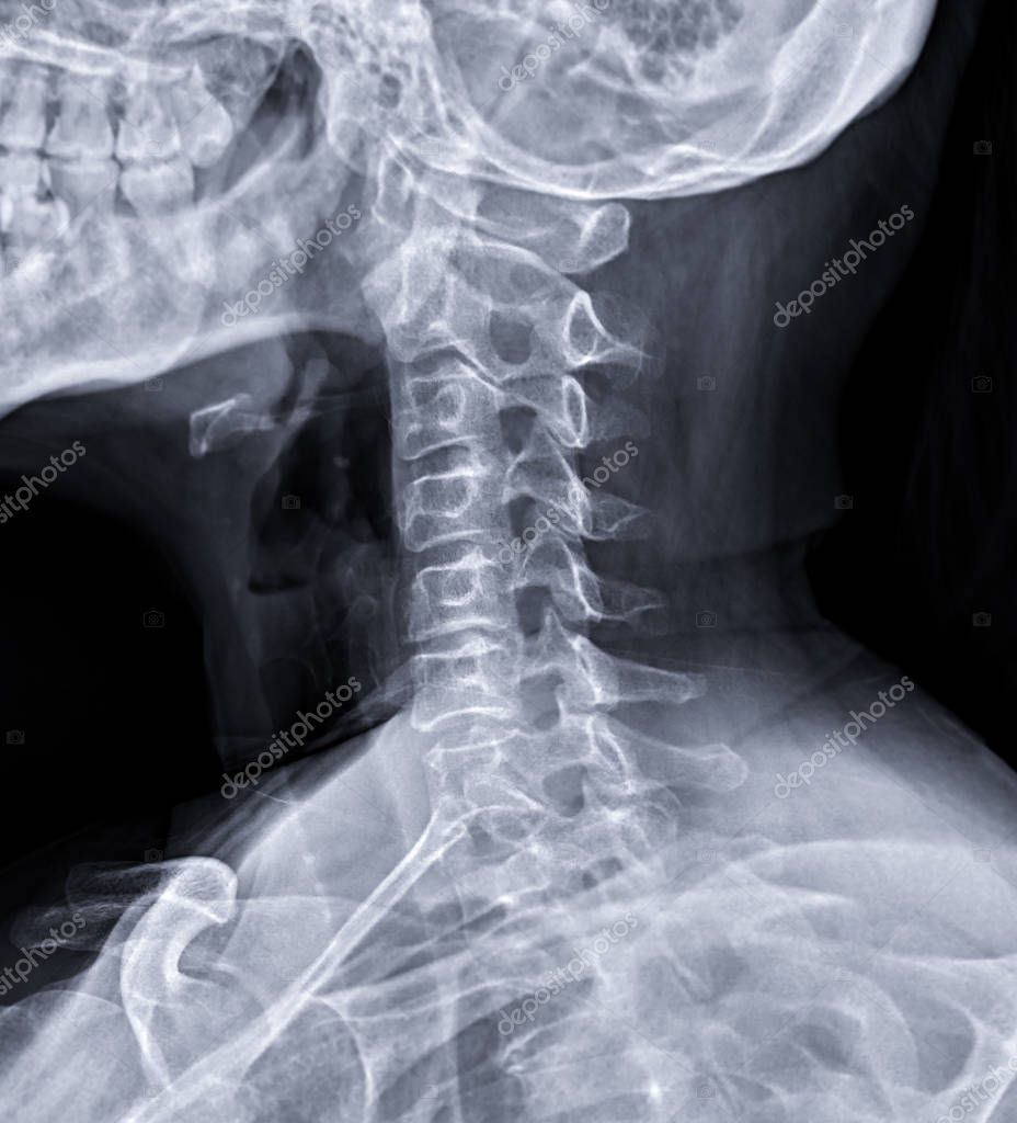 Radiografía de la columna C o radiografía de la columna cervical vista ...