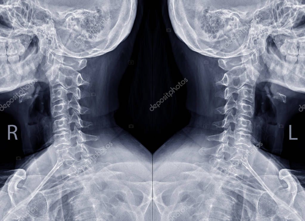Colección de radiografías de columna C o radiografía de columna ...