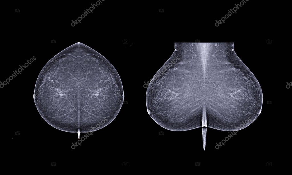Posición básica Radiografía Mamografía digital ambos nombres laterales ...