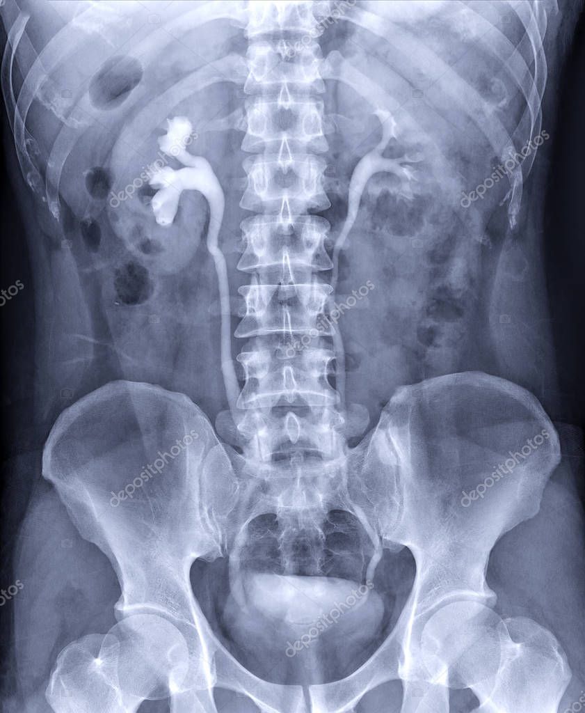 El pielograma intravenoso o I.V.P es un examen de rayos X del tracto ...