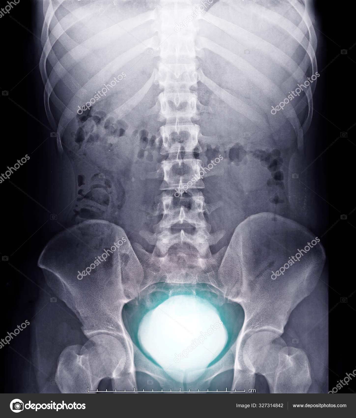 Pielograma Intravenoso Examen Rayos Del Tracto Urinario Después Del ...