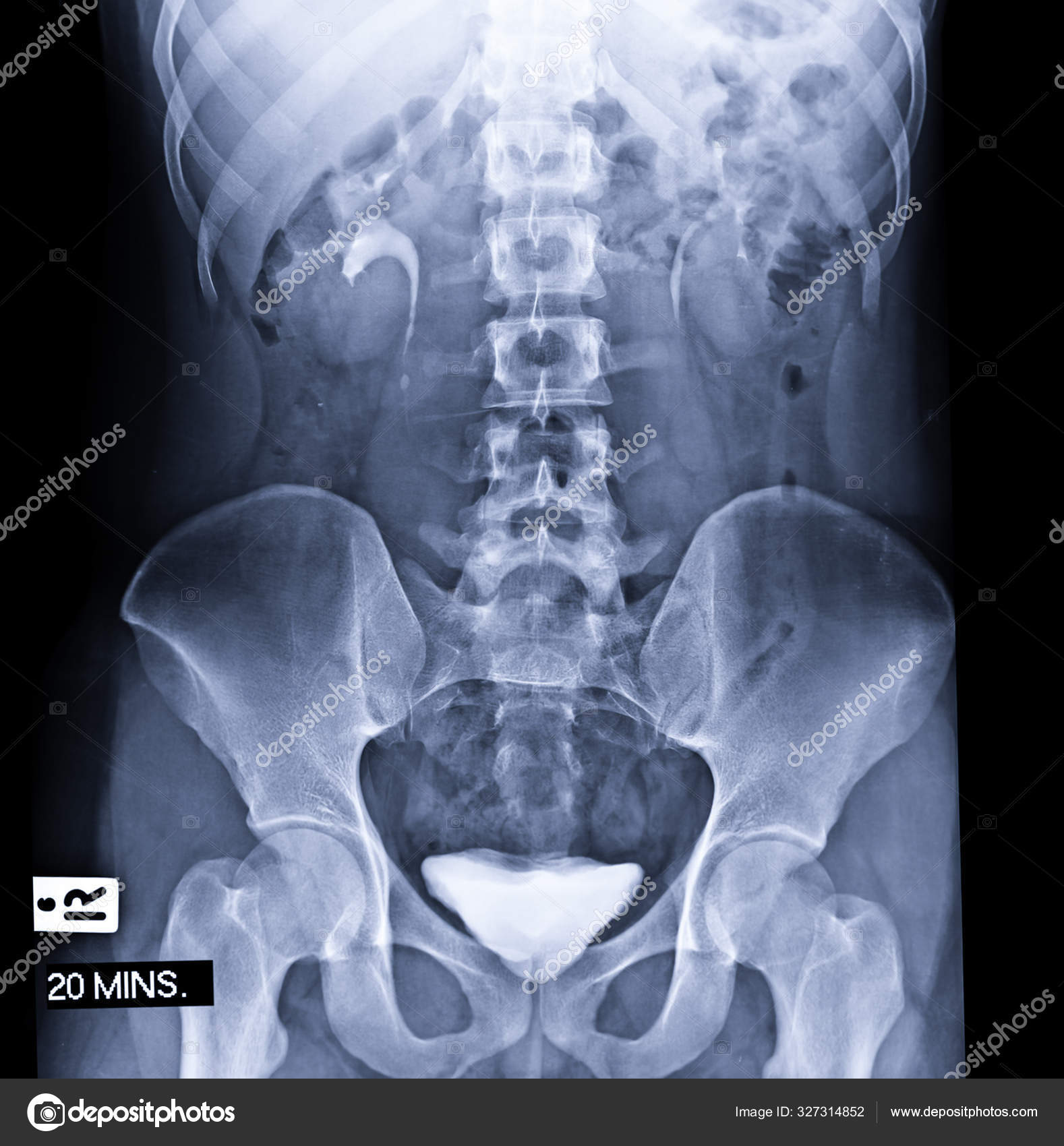Intravenous Pyelogram Ray Exam Urinary Tract Injection Contrast Media
