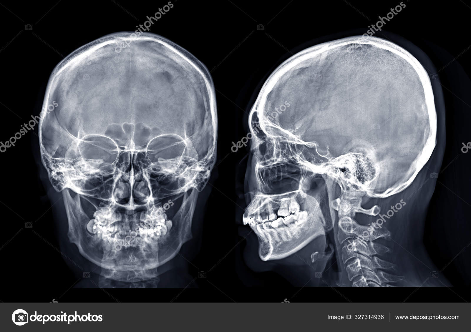 Skull Ray Image Human Skull Lateral Isolated Black Background Stock ...