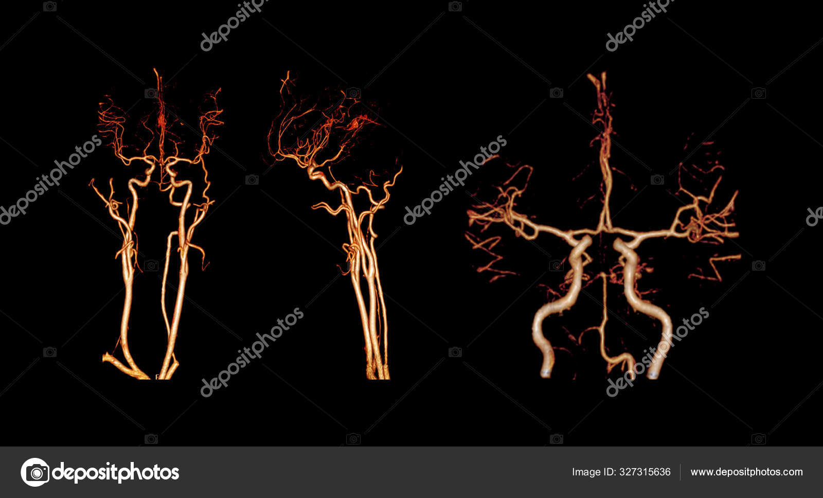 Cta Brain Angiography Brain Rendering Image Showing Common Carotid ...