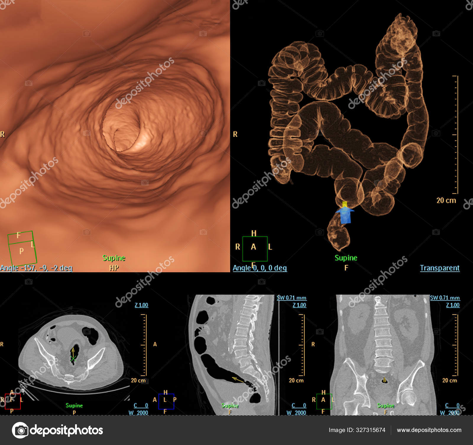 Colonography Compare Axial Sagittal Coronal Plane Rendering Image ...