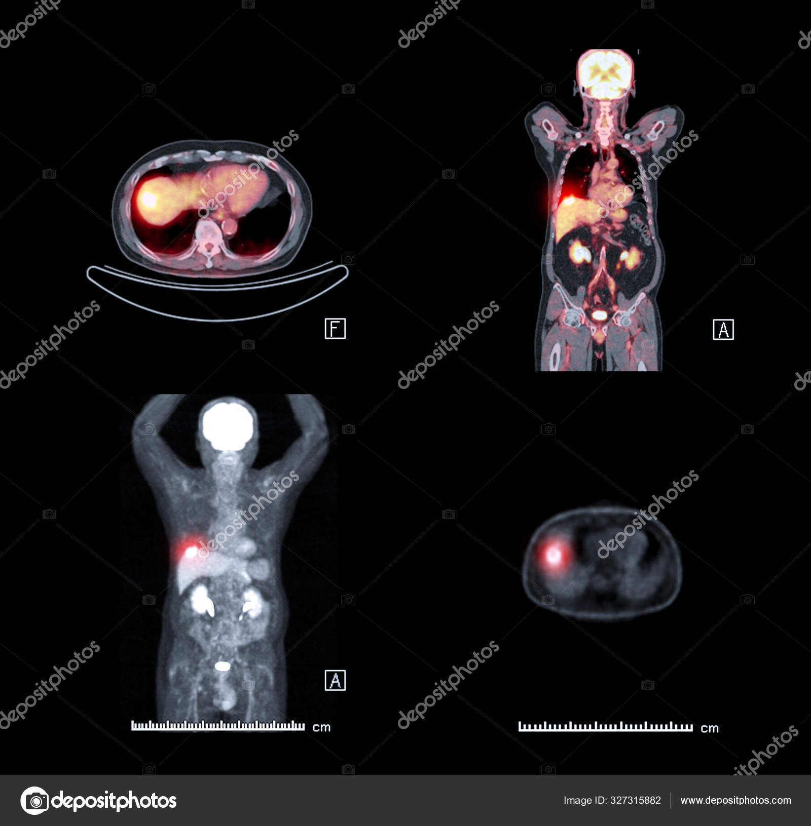 Pet Scan Image Whole Body Comparison Axial Sagittal Plane Detect Stock ...