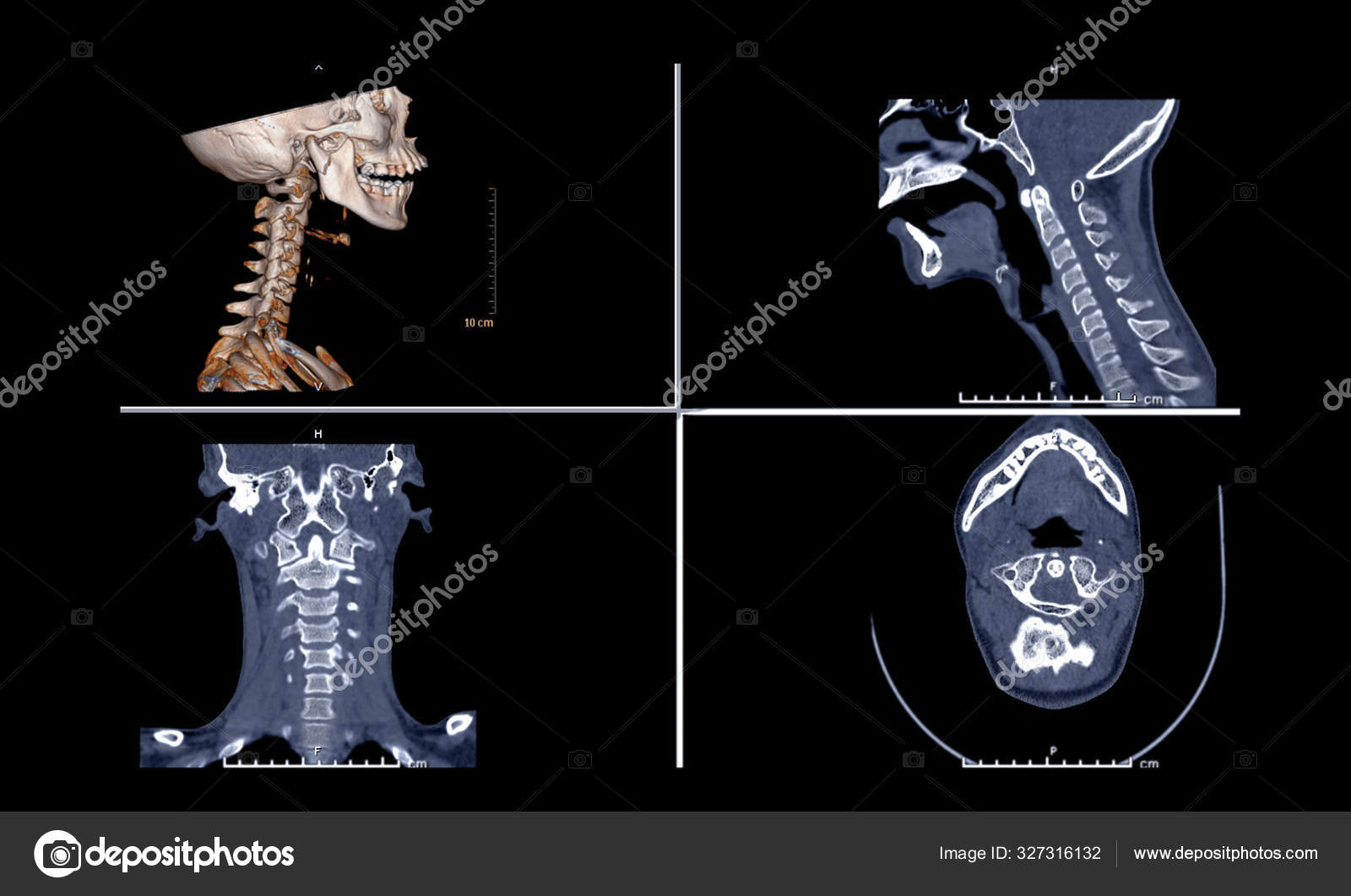 Comparison Spine Cervical Spine Rendering Image Sagittal Corona Axiall ...