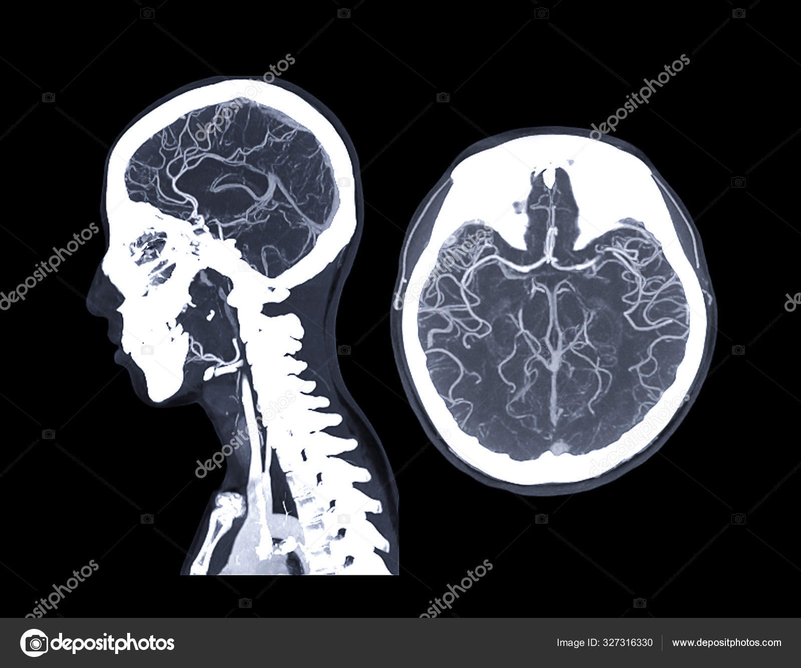 Angiography Brain