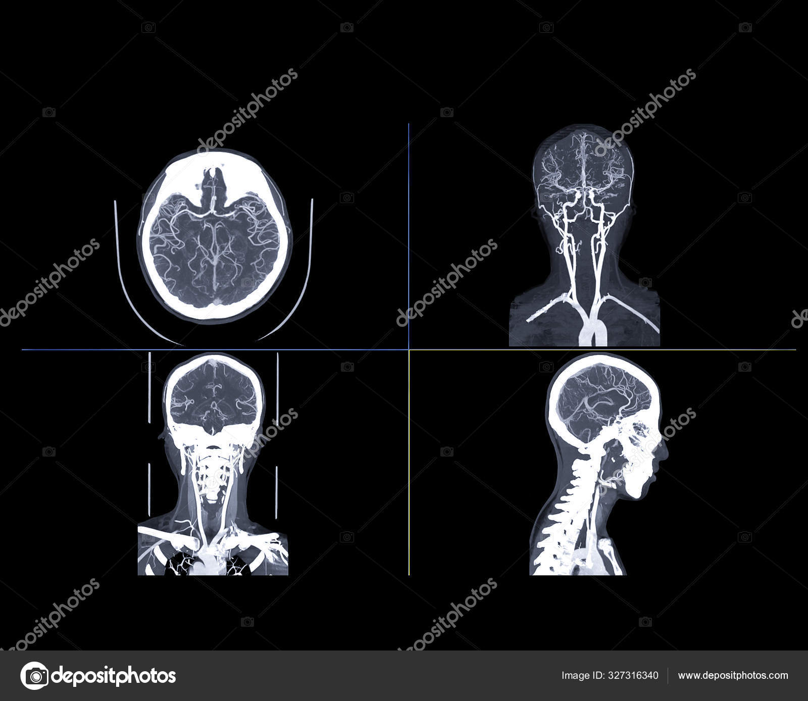 Cta Brain Angiography Brain Comparison Coronal Sagittal View Fusion ...