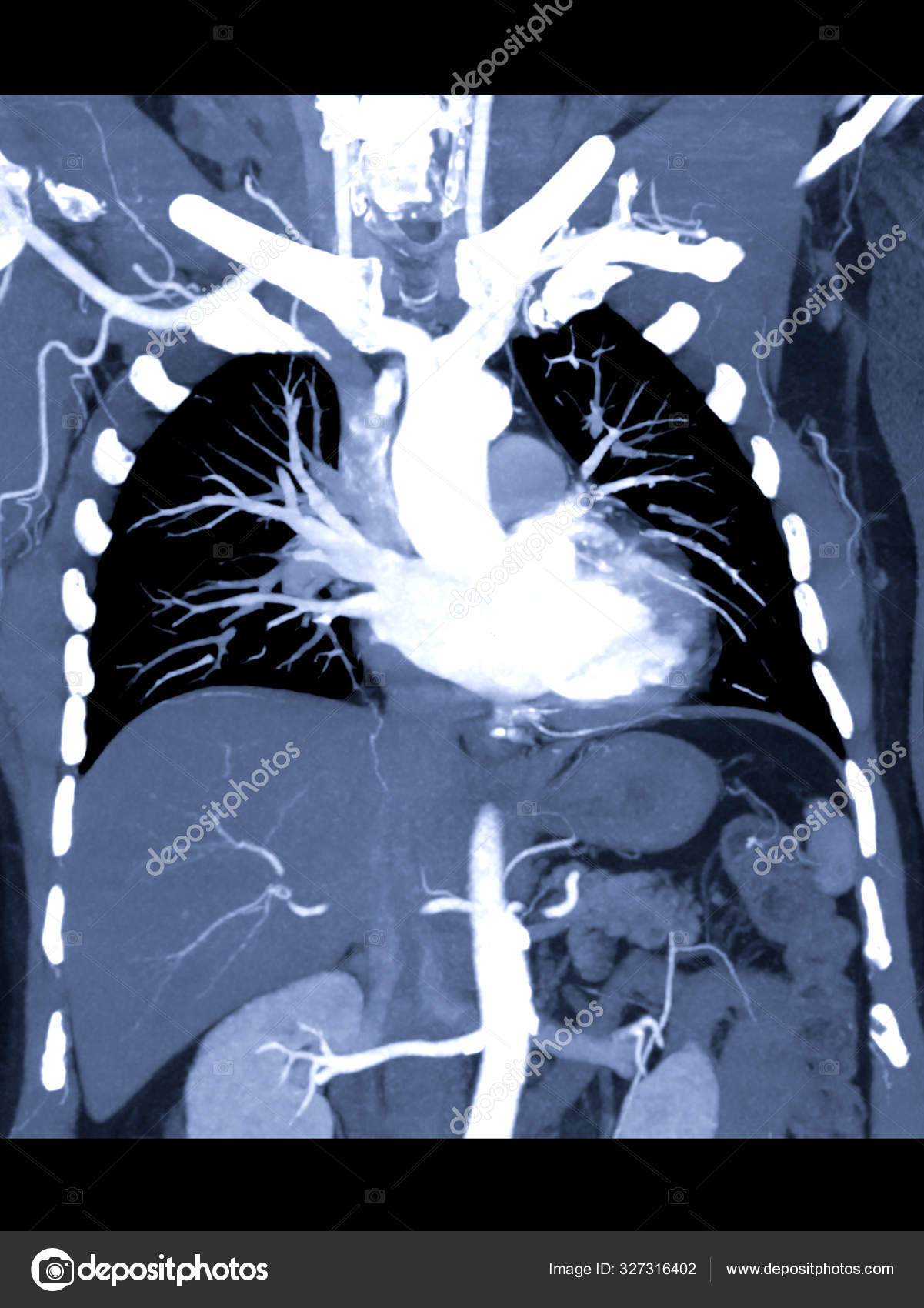 Cta Thoracic Aorta Mip Image Injection Contrast Media Thoracic Aorta ...