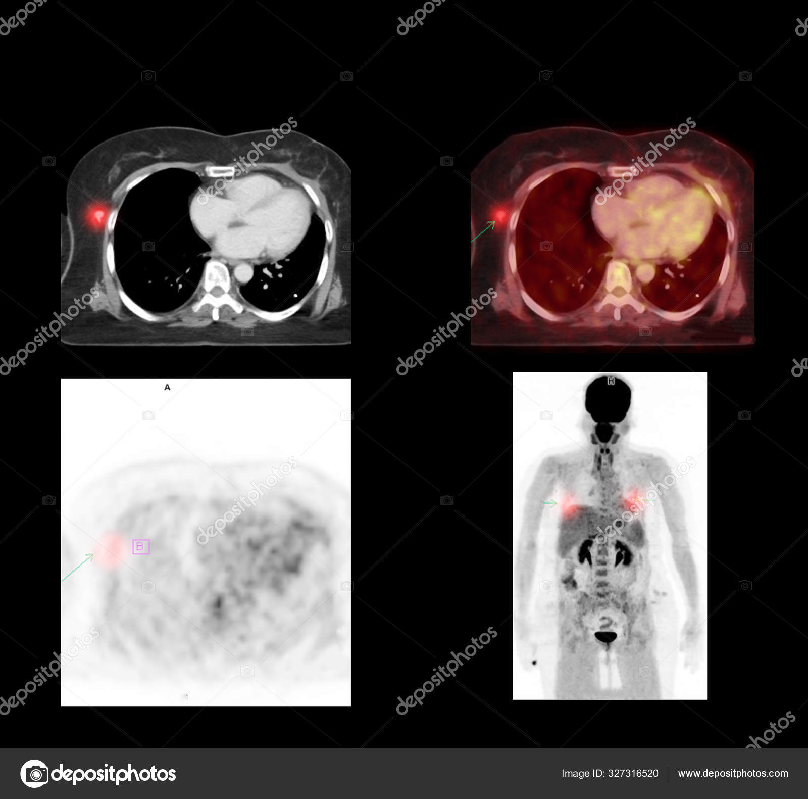 Pet Scan Images Lung Cancer
