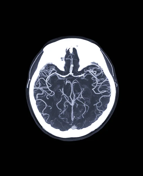 Angiography Brain Cta Brain Showing Cerebral Artery — Stock Photo ...