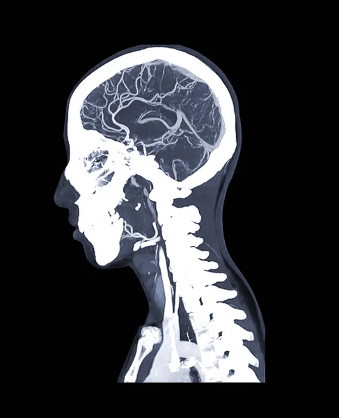 Cta Brain Angiography Brain Sagittal Axial Mip View Medical Technology ...
