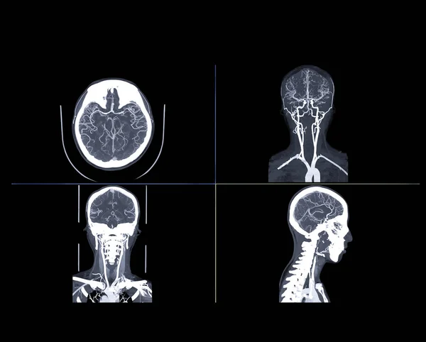 Cta Brain Angiography Brain Sagittal Axial Mip View Medical Technology ...