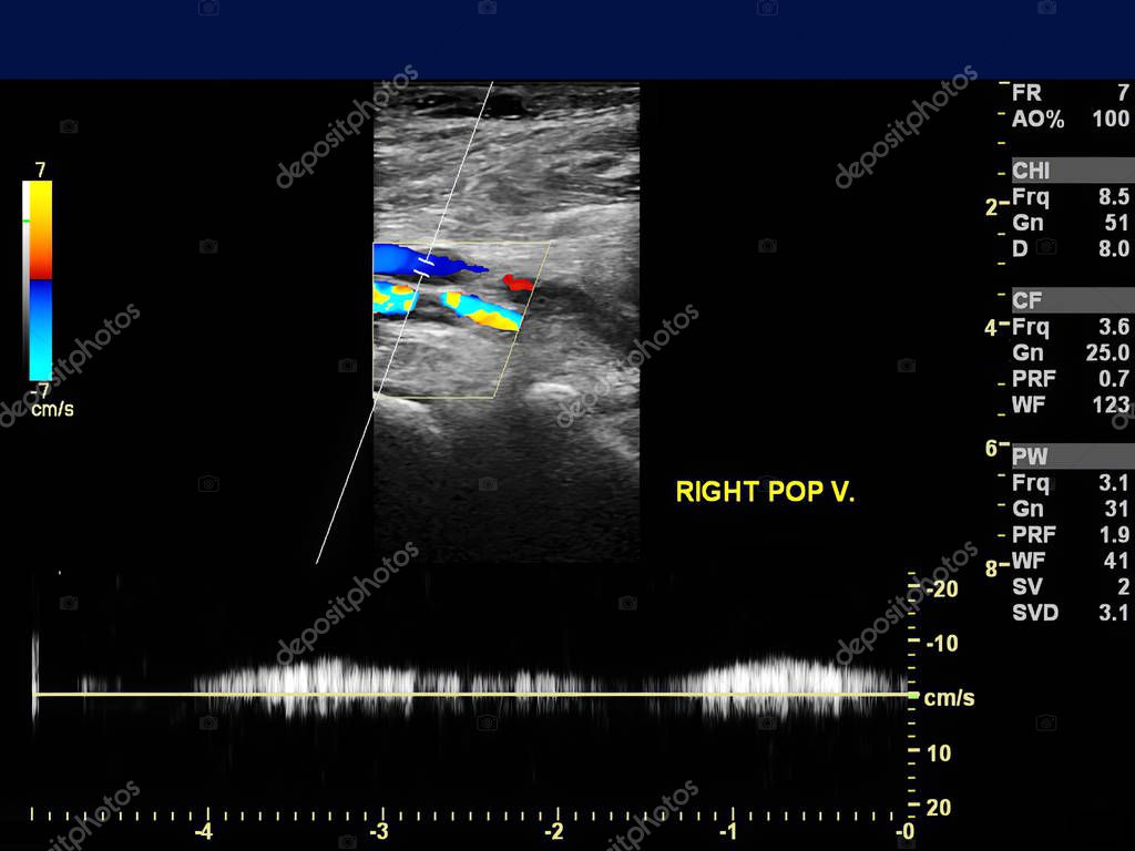 Ultrasonido doppler de vien poplíteo para encontrar trombosis venosa ...