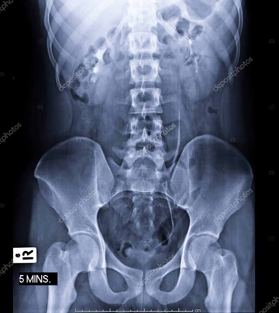 Comparación de pielograma intravenoso o I.V.P es un examen de rayos X ...