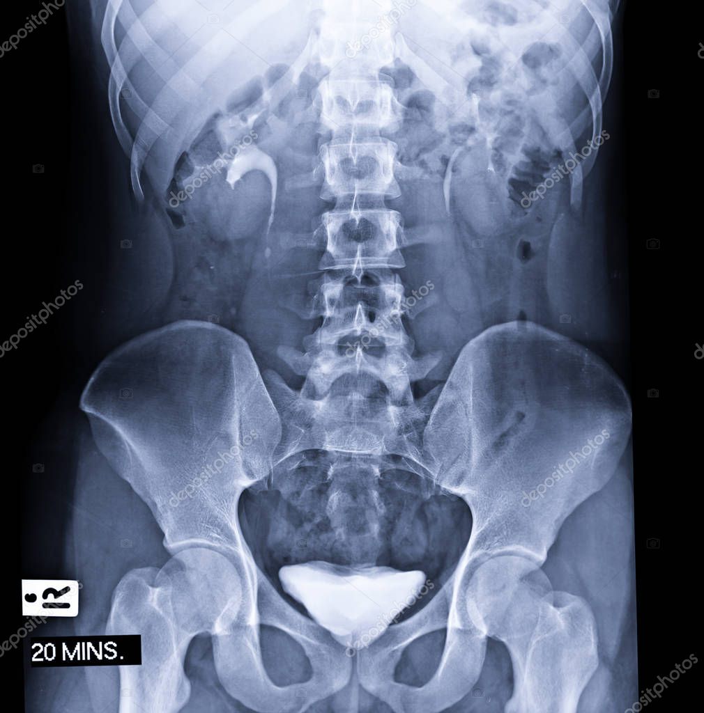 El pielograma intravenoso o I.V.P es un examen de rayos X del tracto ...