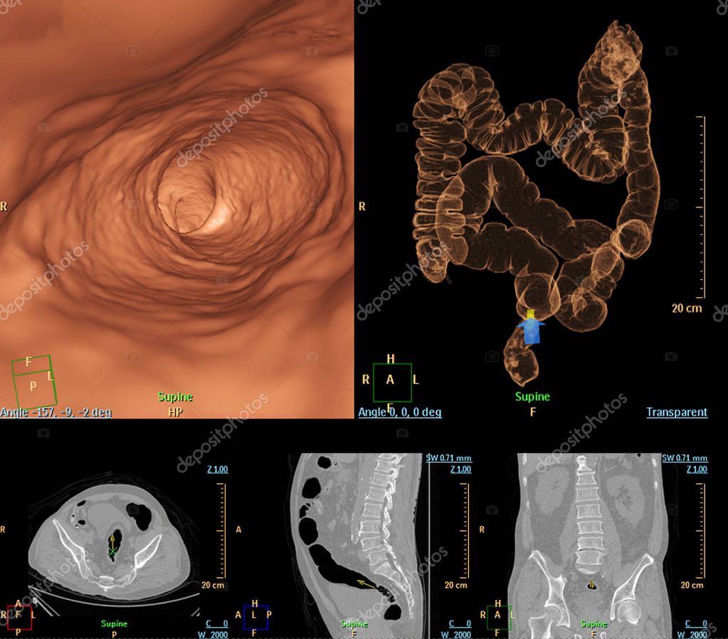 La colonografía por TC compara la imagen axial, sagital, coronal y 3D ...